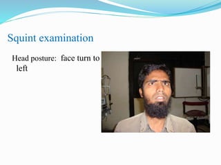 traumatic abducent nerve palsy | PPTX