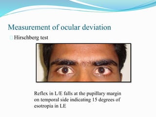 traumatic abducent nerve palsy | PPTX