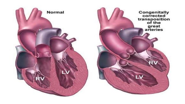 Corrected transposition of great arteries | PPT