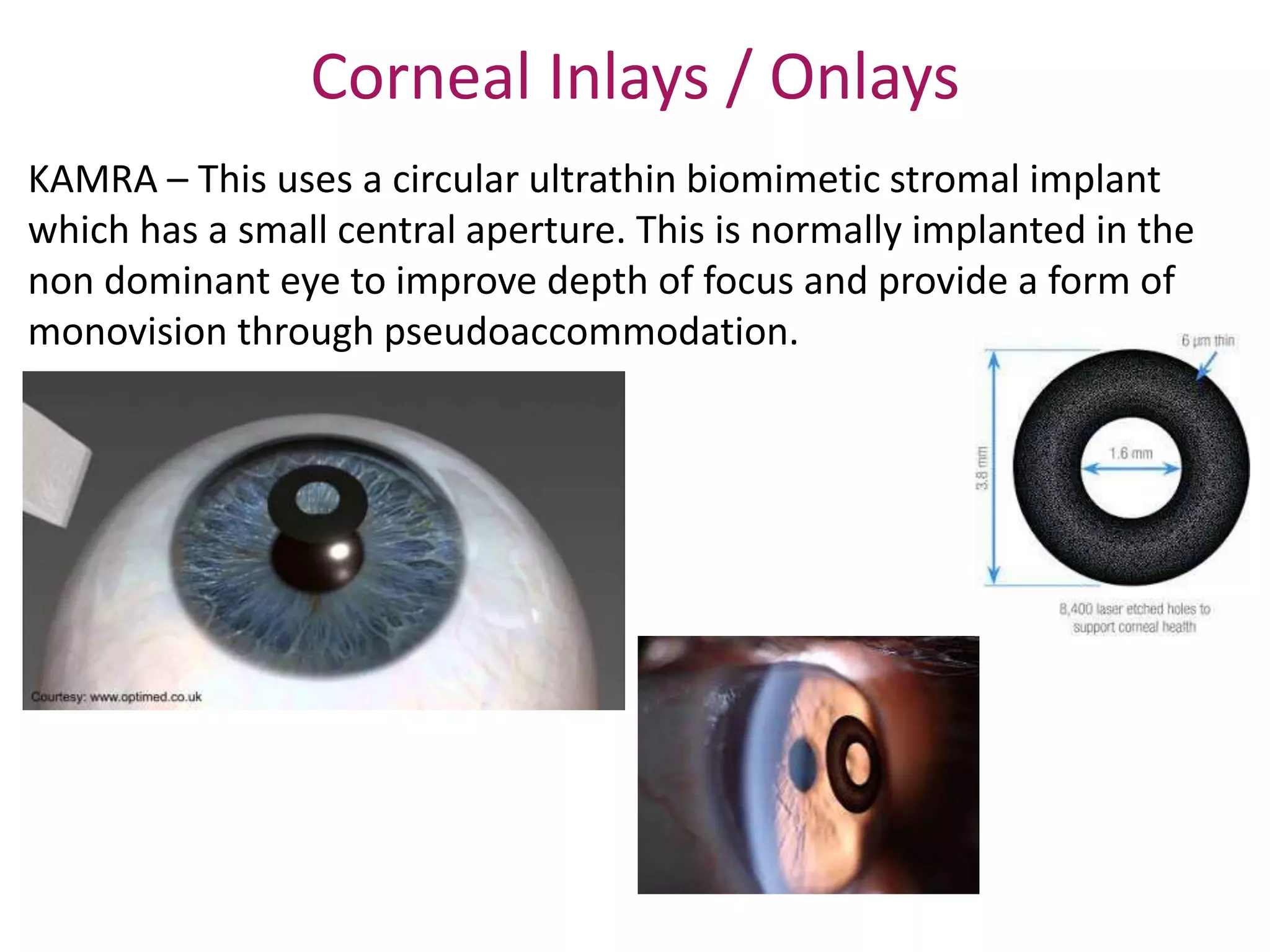Correcting presbyopia - Modern Options | PPTX