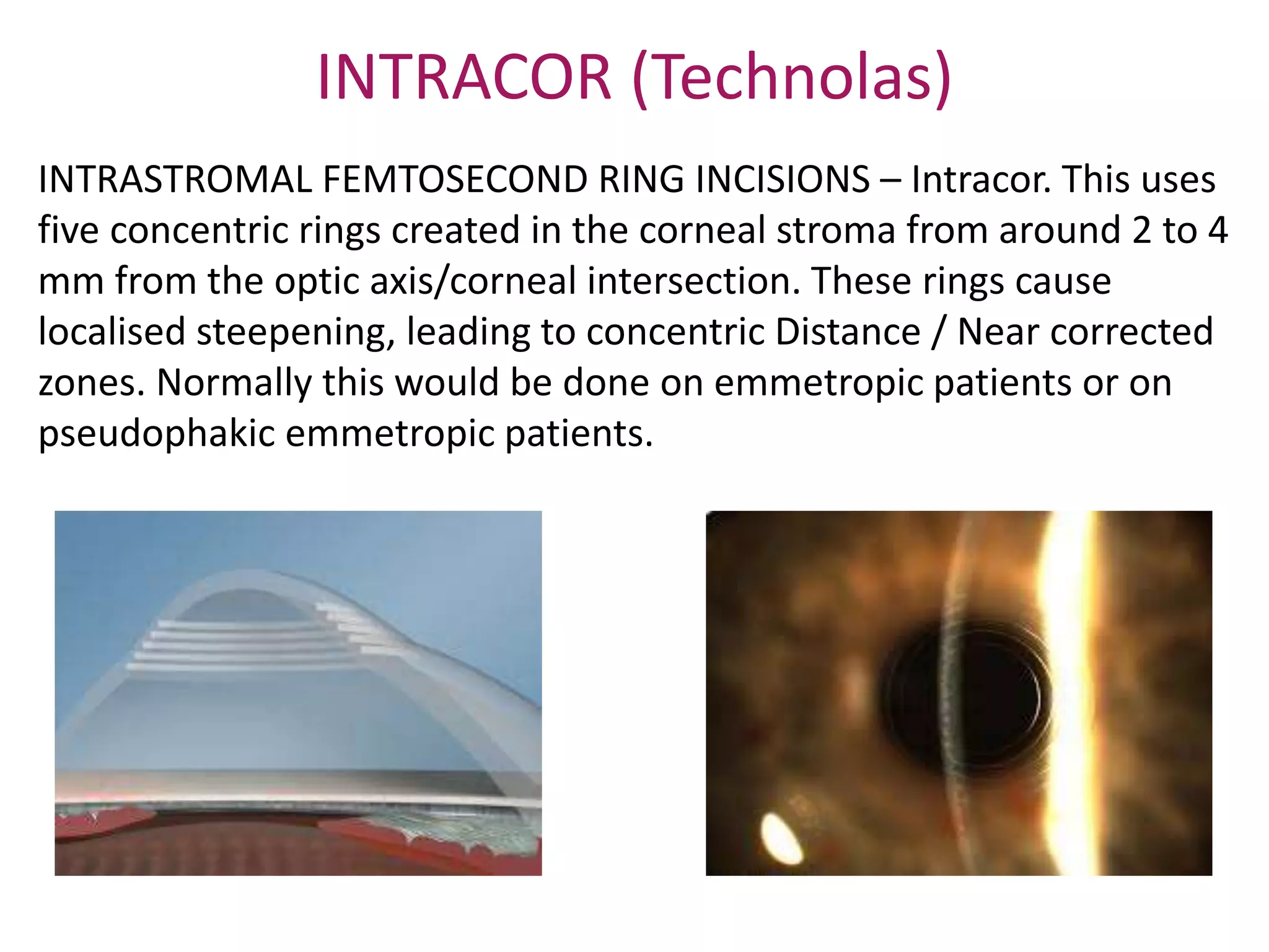 Correcting presbyopia - Modern Options | PPTX
