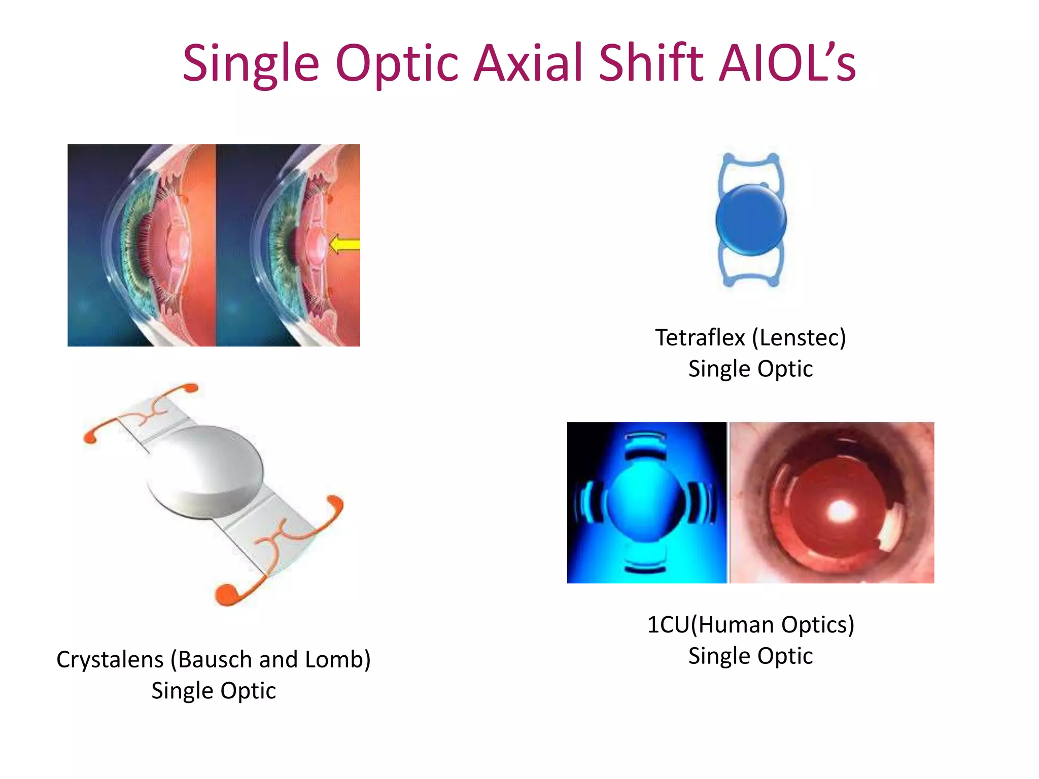 Correcting presbyopia - Modern Options | PPTX