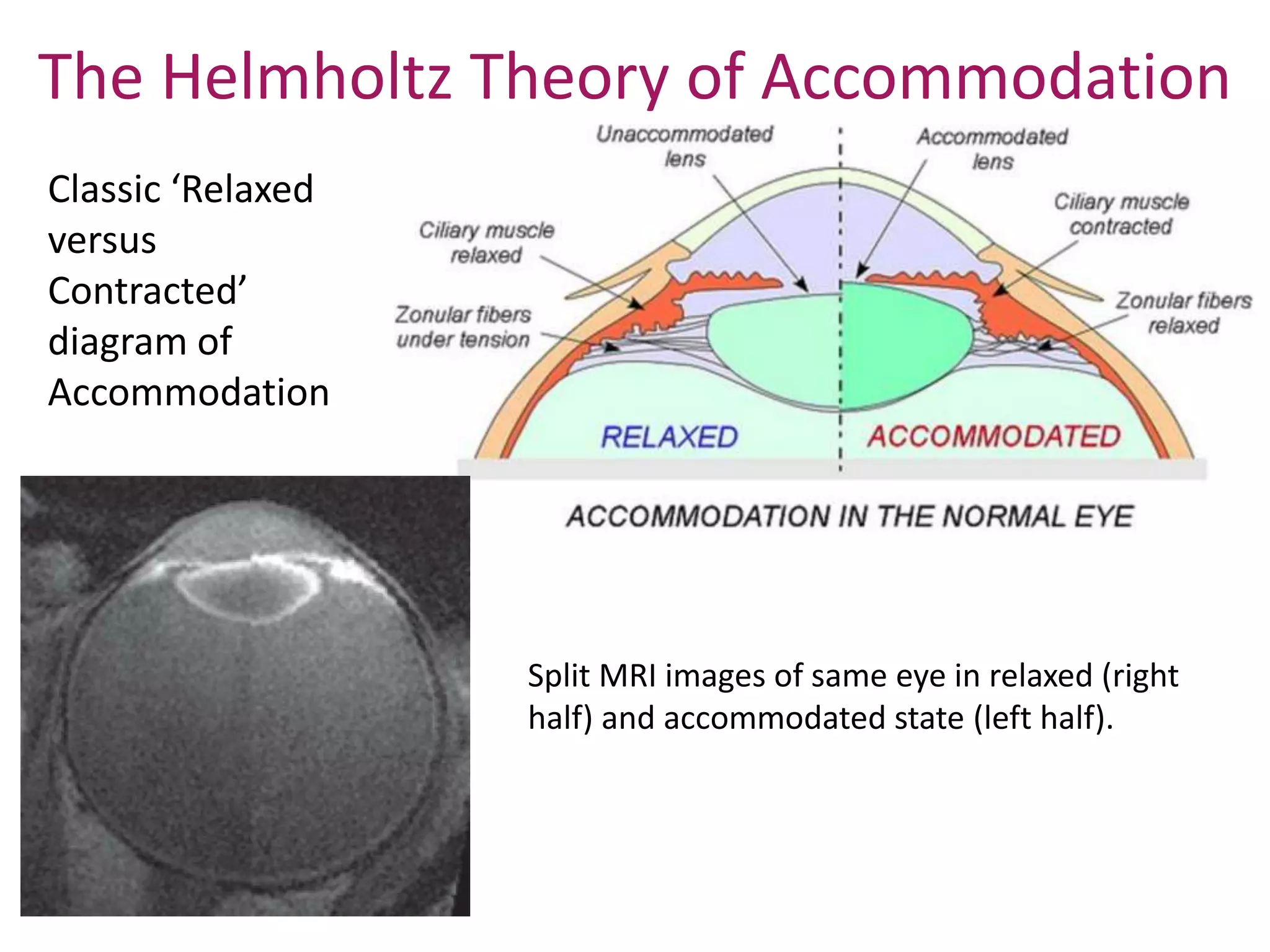 Correcting presbyopia - Modern Options | PPTX