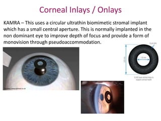 Correcting presbyopia - Modern Options | PPTX