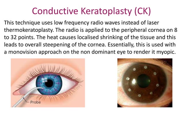 Correcting presbyopia - Modern Options | PPTX | Eye and Vision ...