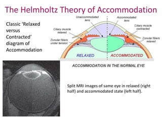 Correcting presbyopia - Modern Options | PPTX