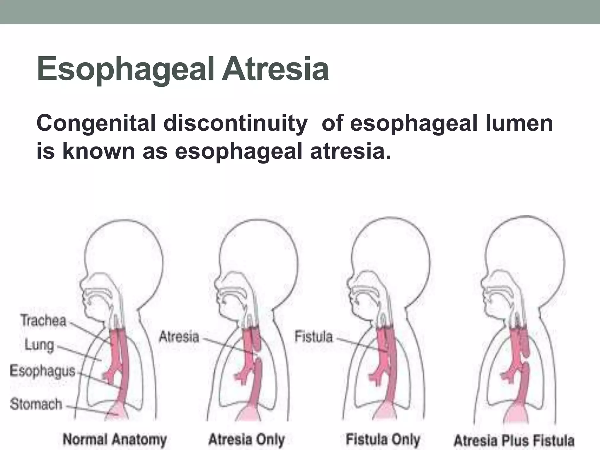 Correction Esophageal Atresia & TEF (Raghu).pptx