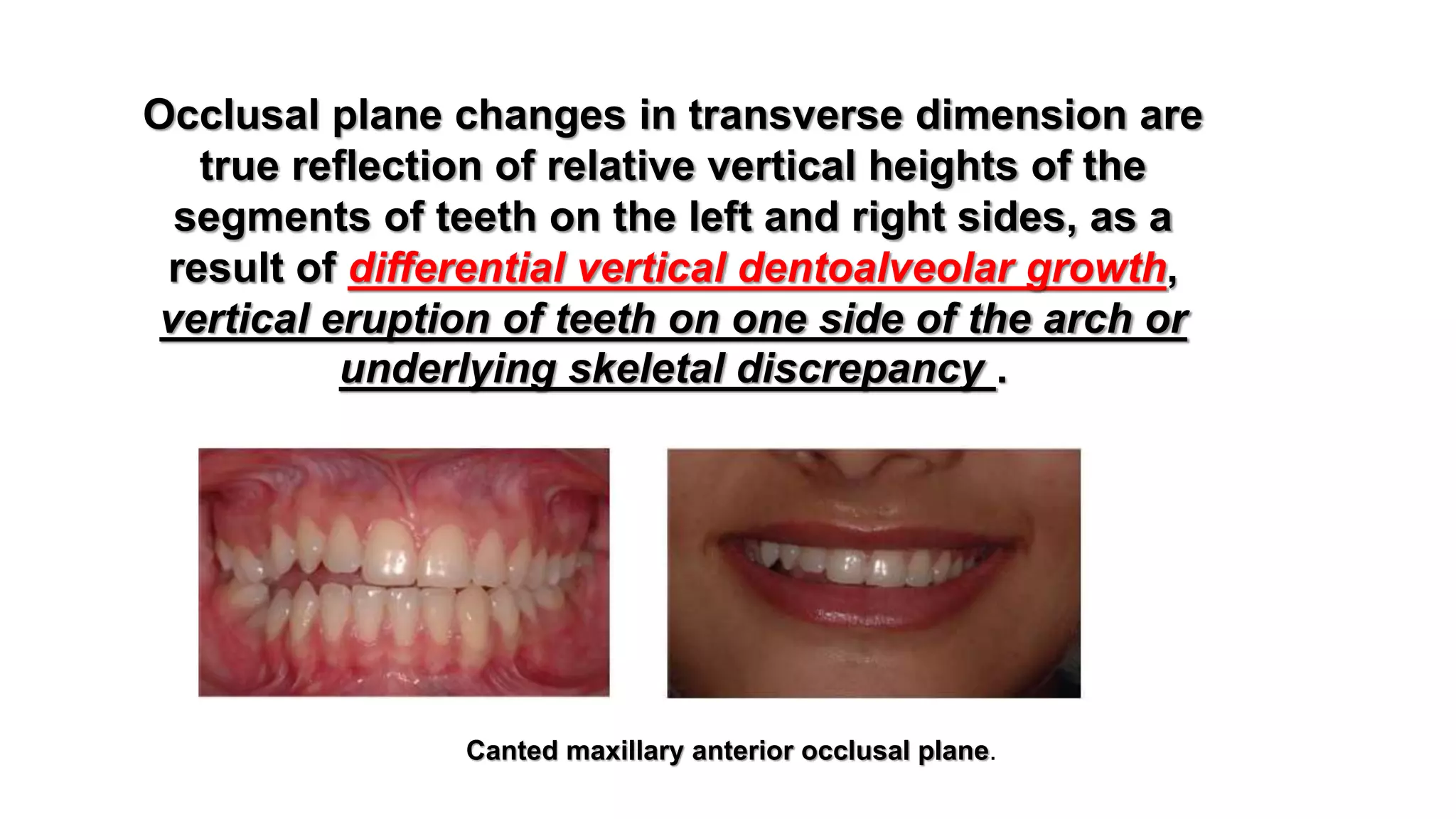 orthodontic correction of canted occlusal plane 2 | PPTX