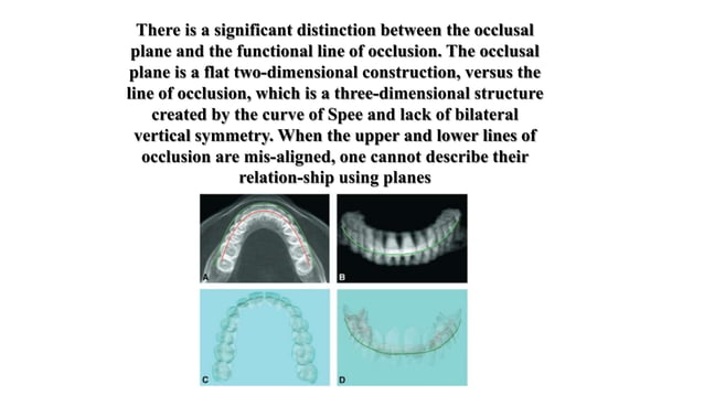 orthodontic correction of canted occlusal plane 2 | PPTX | 3-D Graphics ...
