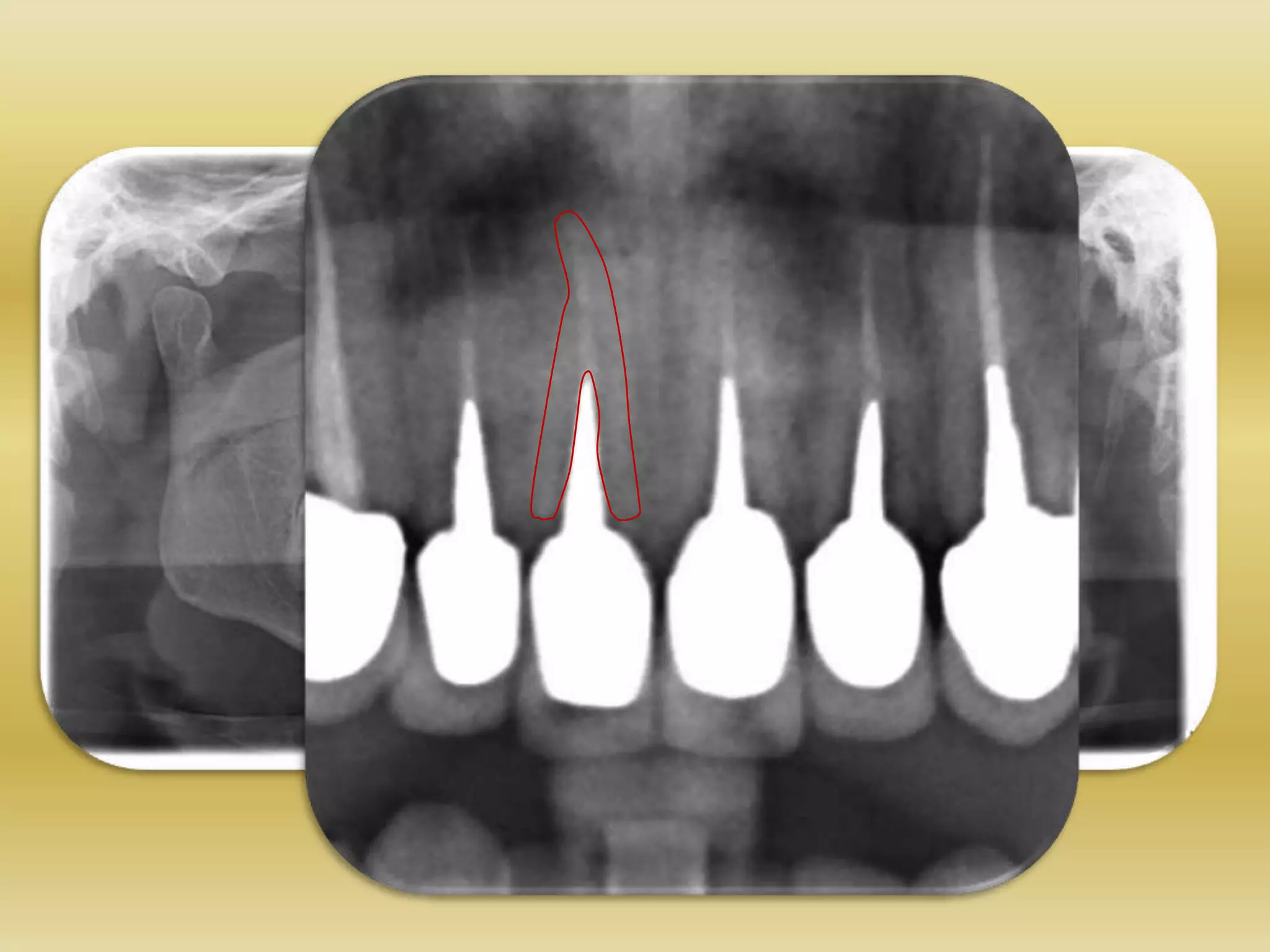 Correction of crowding teeth in adults fdi 2013 (1) | PPT