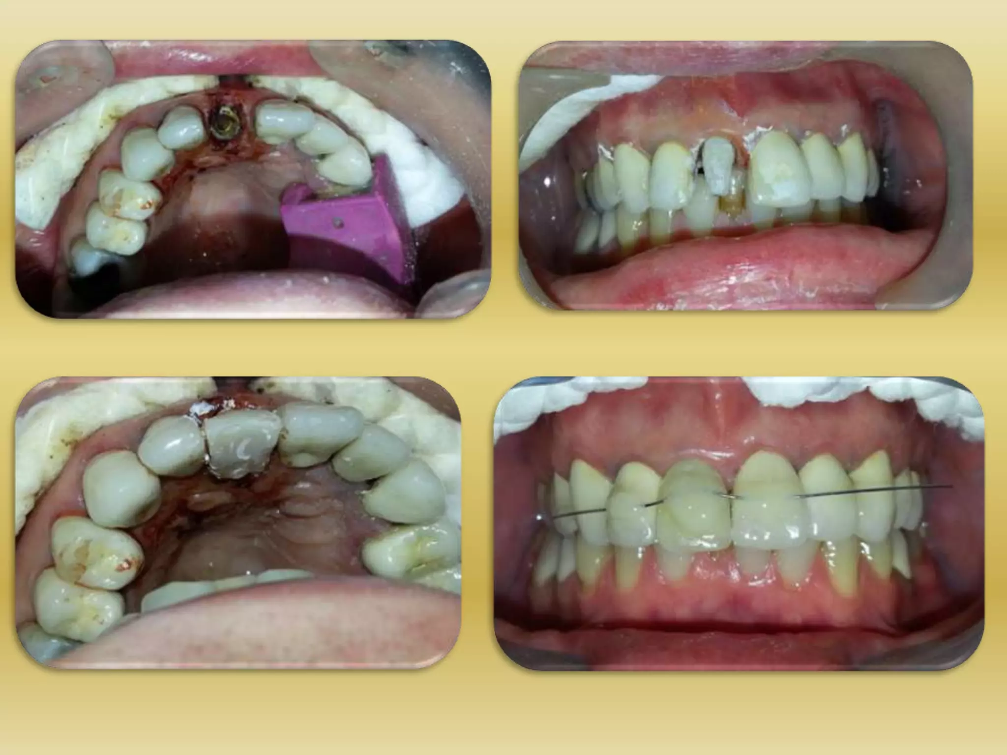 Correction of crowding teeth in adults fdi 2013 (1) | PPT