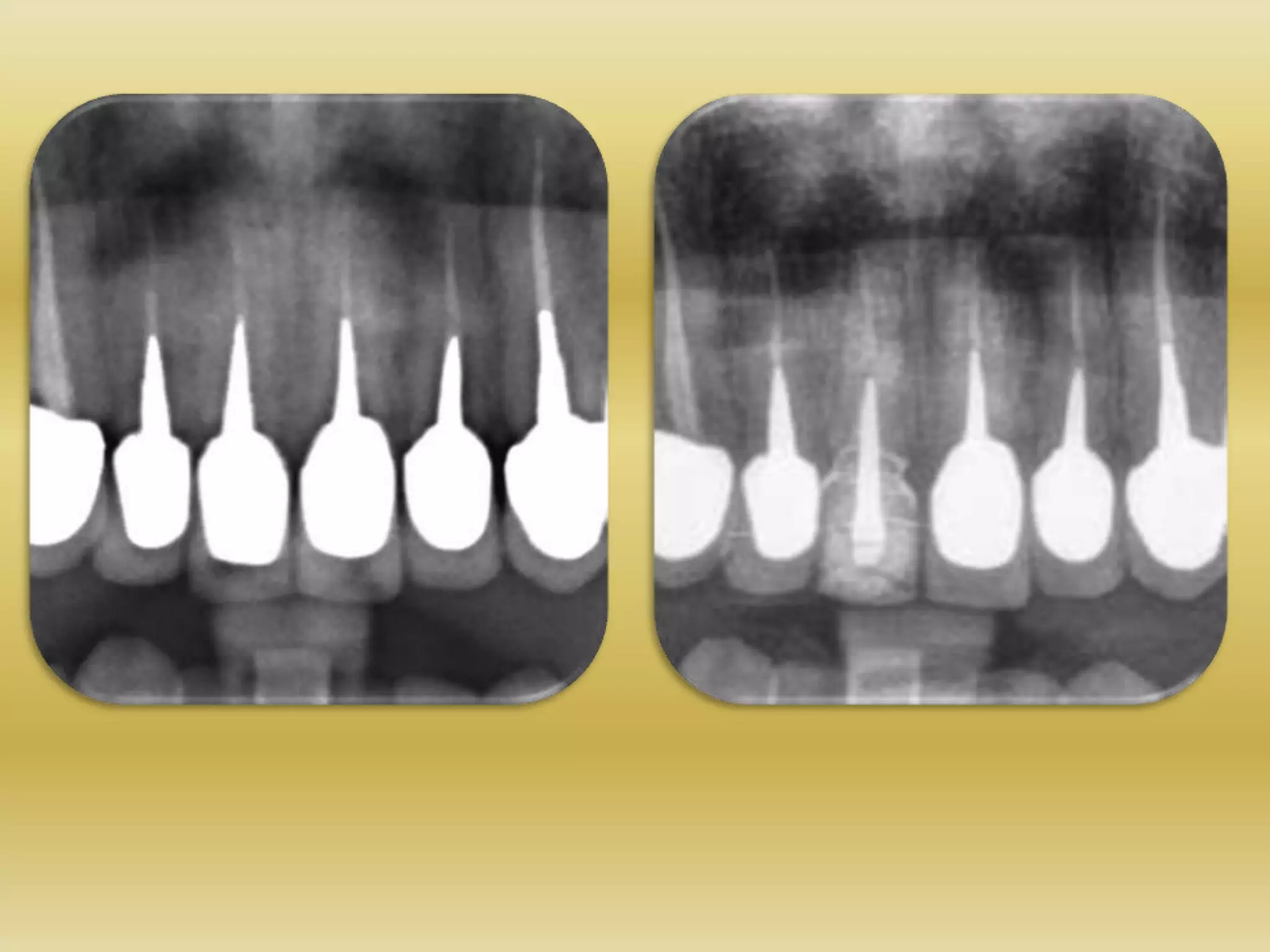 Correction of crowding teeth in adults fdi 2013 (1) | PPTX