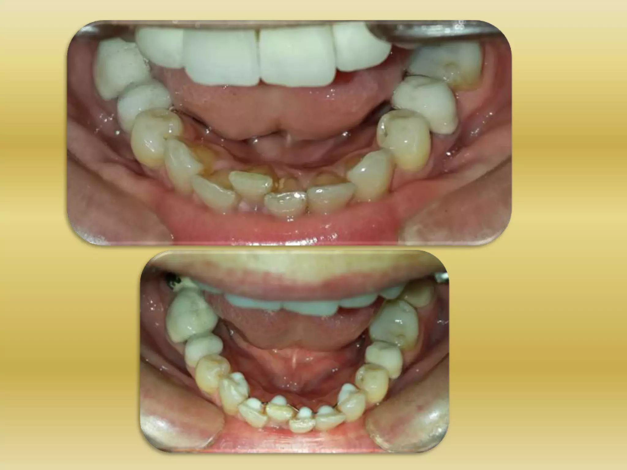 Correction of crowding teeth in adults fdi 2013 (1) | PPTX
