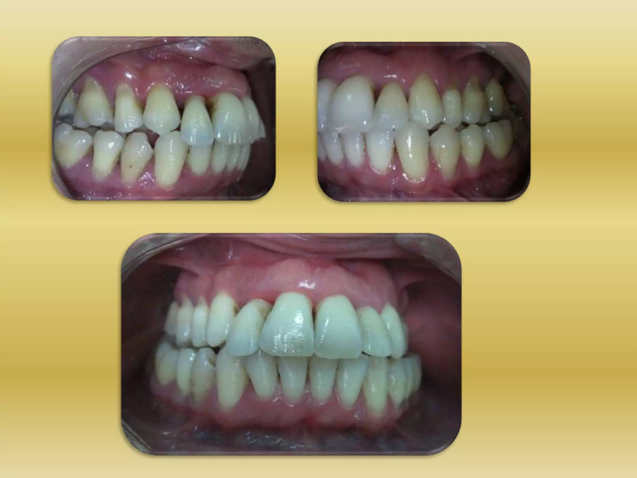 Correction of crowding teeth in adults fdi 2013 (1) | PPT