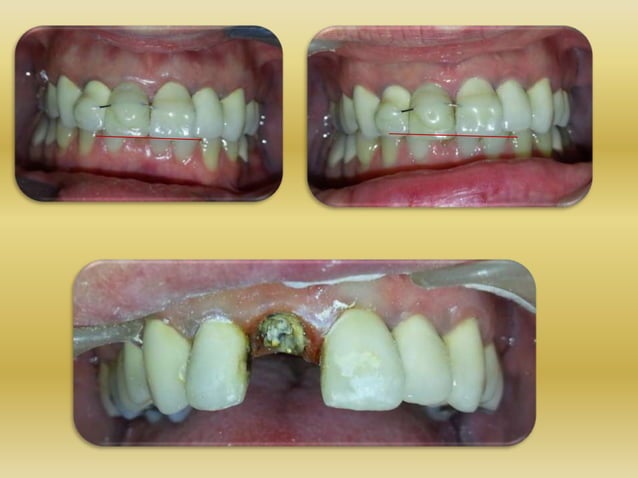 Correction of crowding teeth in adults fdi 2013 (1) | PPTX