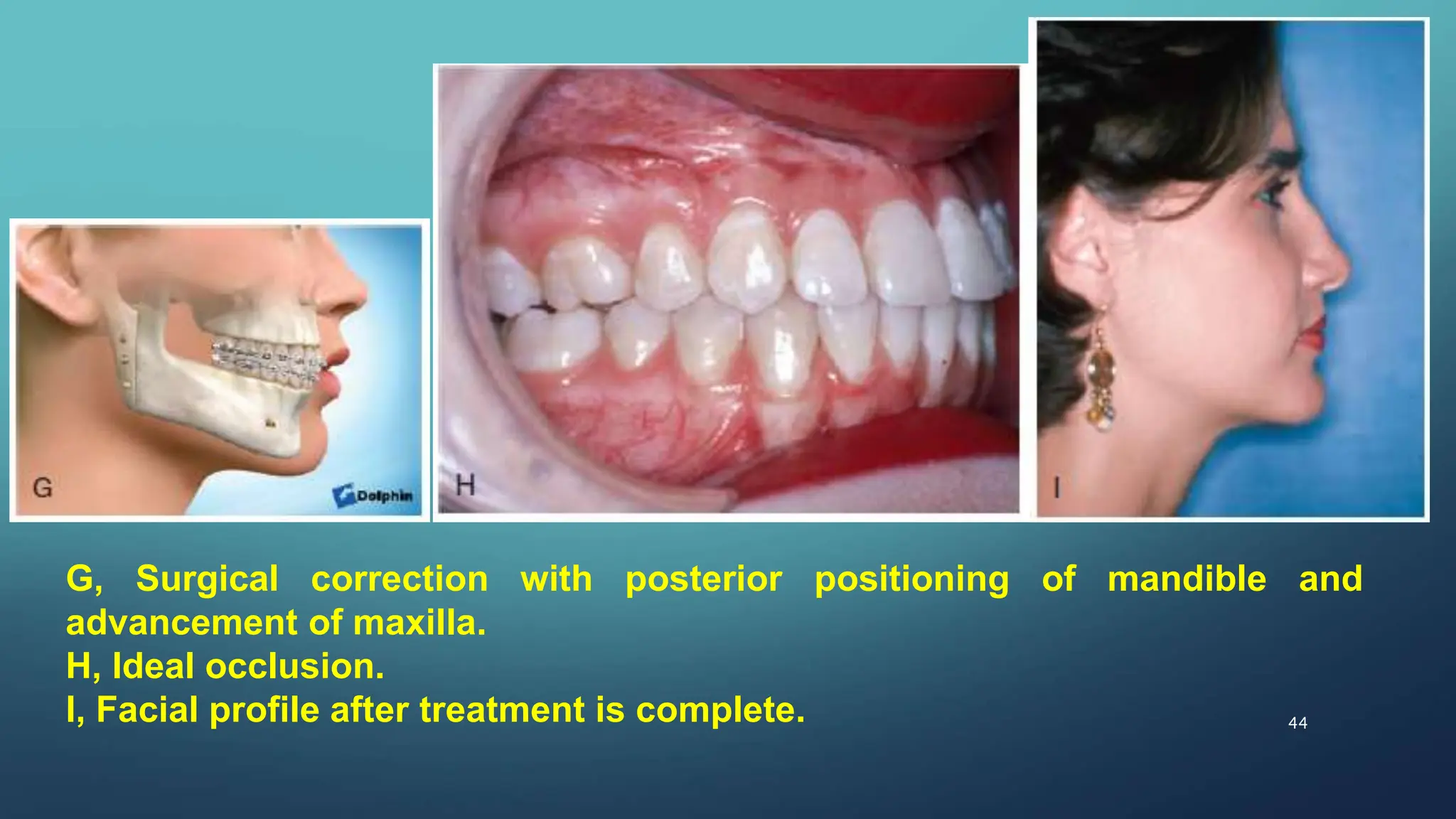 Correctionofdentofacial deformities.pptx