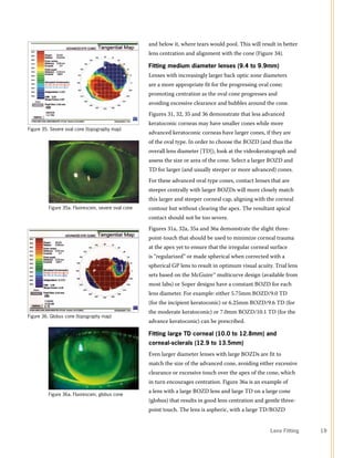 Correction of Keratoconus with GP Lenses | PDF