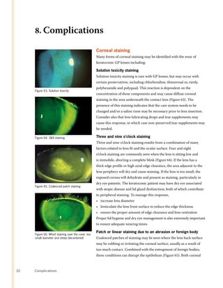 Correction of Keratoconus with GP Lenses | PDF