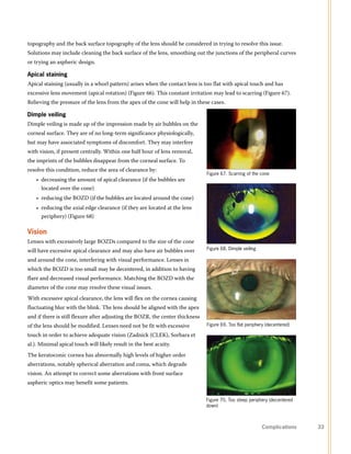 Correction of Keratoconus with GP Lenses | PDF
