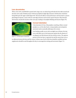 Correction of Keratoconus with GP Lenses | PDF