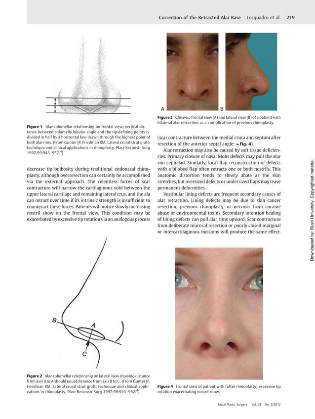 Correction of the retracted alar base | PDF