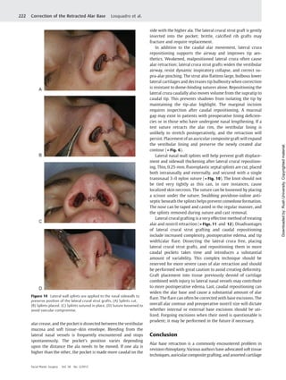 Correction of the retracted alar base | PDF
