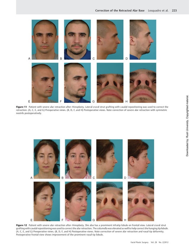 Correction of the retracted alar base | PDF
