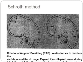 Corrective exercises in the treatment of scoliosis | PPTX