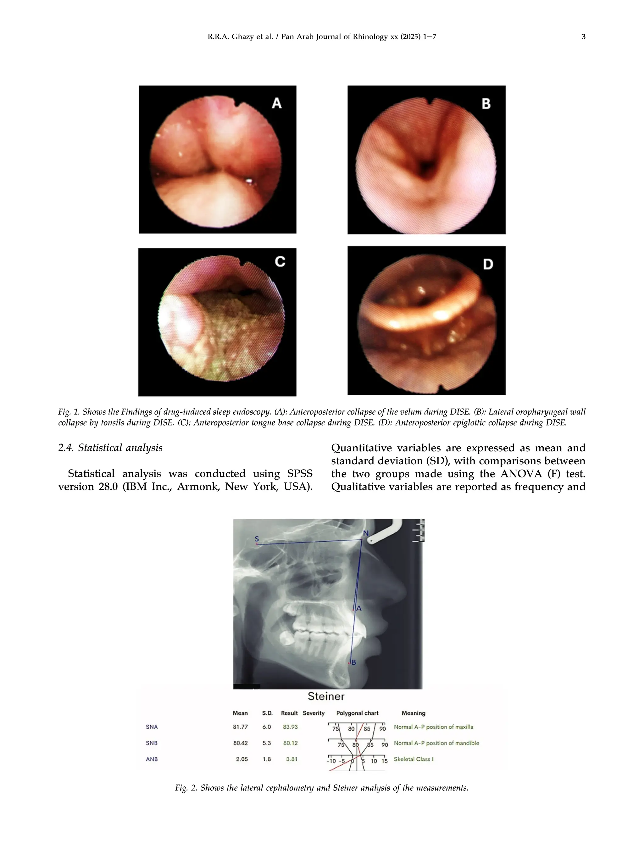 Correlation Between Drug-Induced Sleep Endoscopy and Lateral Ceph.pdf