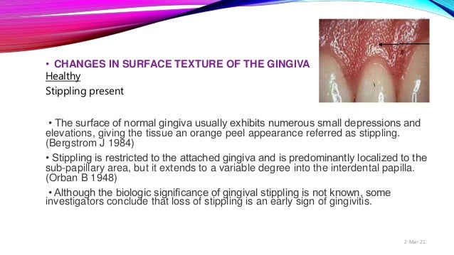 Correlation of clinical features of gingiva | PPTX