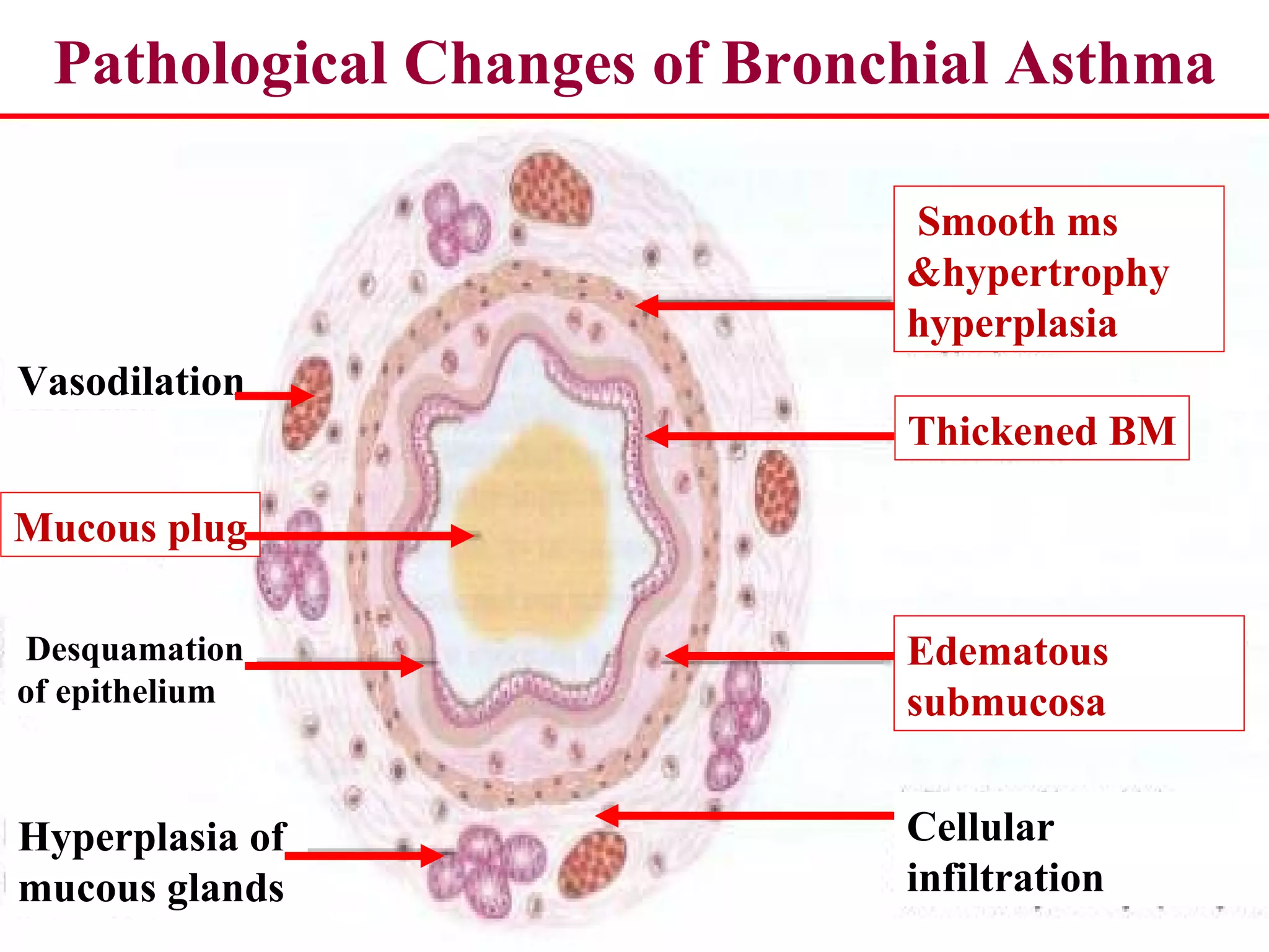 pathophysiology & immunity of asthma | PPT