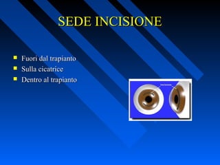 Correzione astigmatismo post cheratoplastica (PK, DALK) | PPT