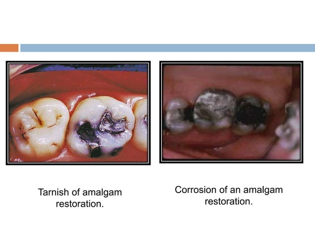 Tarnish and Corrosion | PPTX | Dental Health | Diseases and Conditions