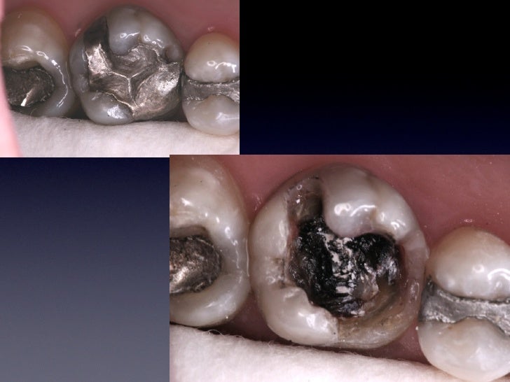 Dental Corrosion at Timothy Gordon blog