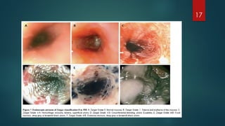 CORROSIVE ESOPHAGEAL INJURY.pptx