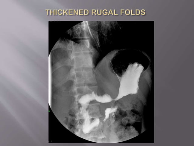 Corrosive ingestion | PPT