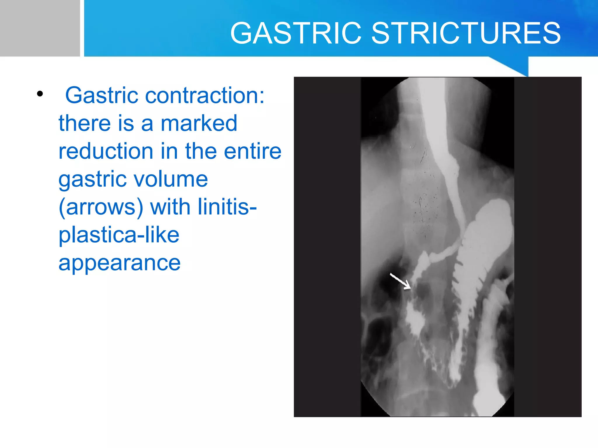 Corrosive injuries vishal | PPT
