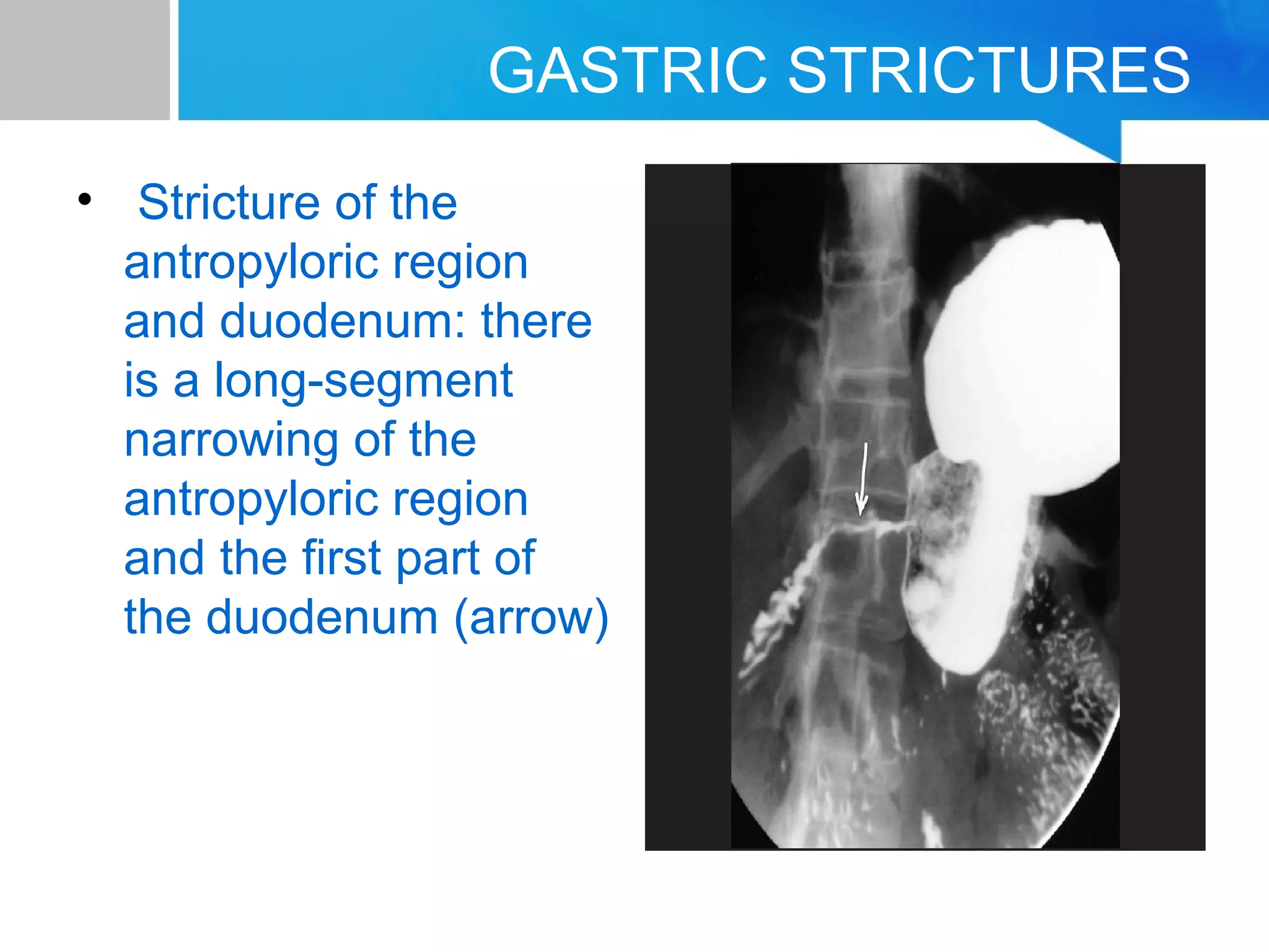 Corrosive injuries vishal | PPT