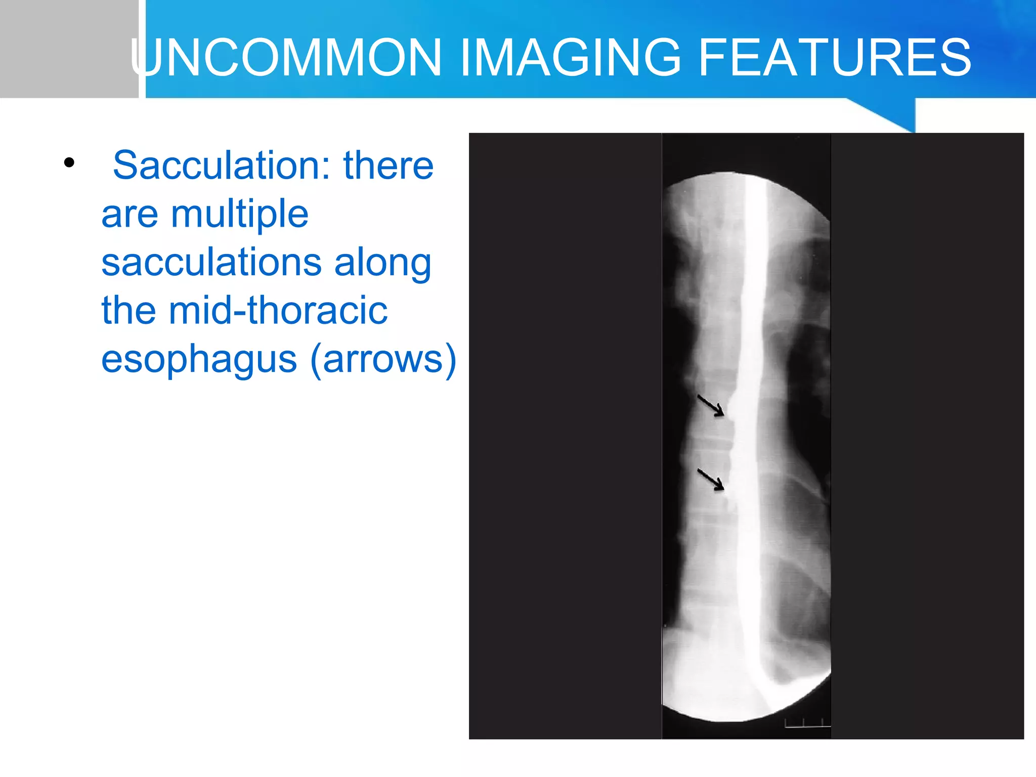 Corrosive injuries vishal | PPT