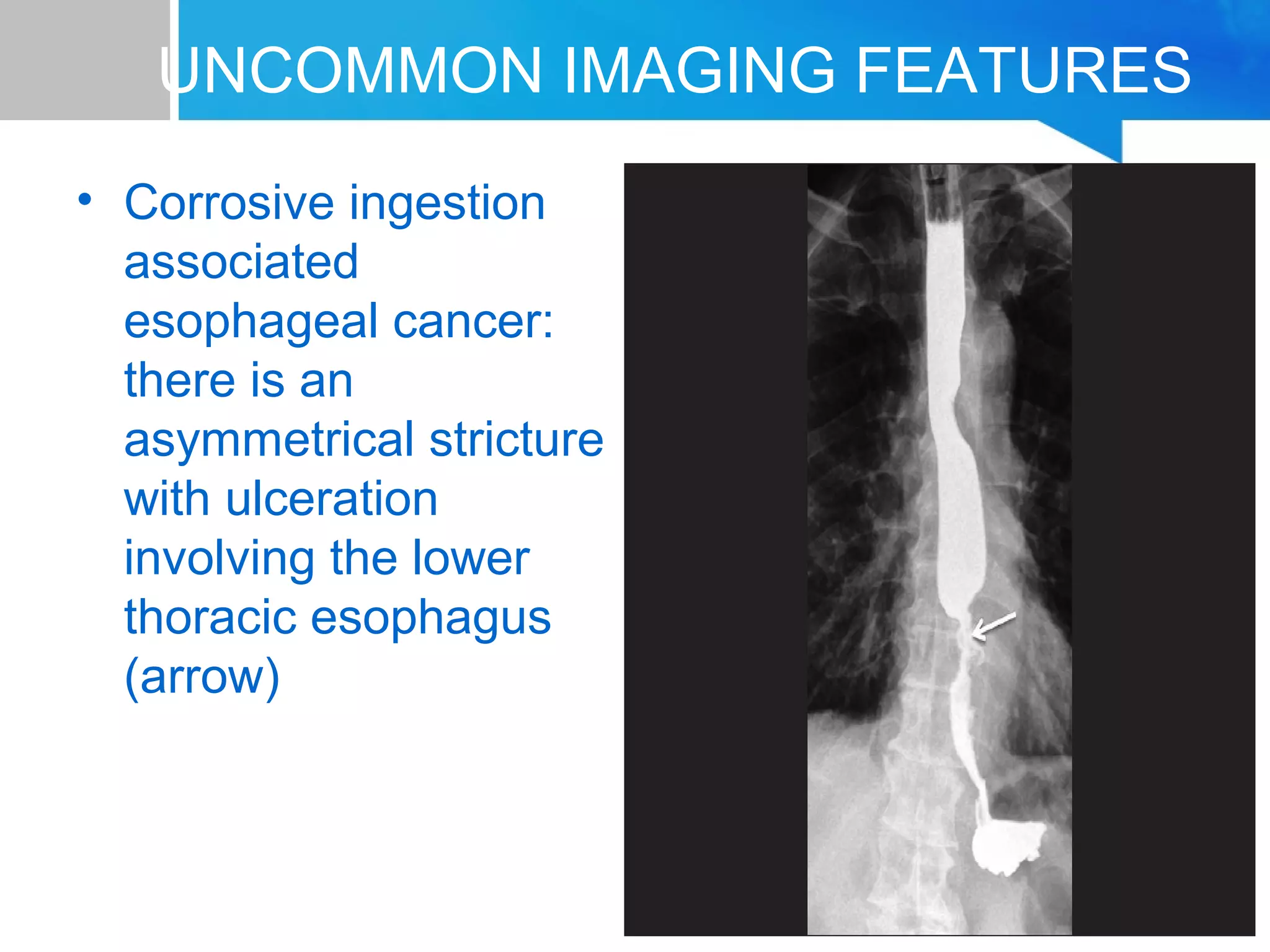 Corrosive injuries vishal | PPT