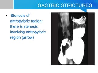 Corrosive injuries vishal | PPT