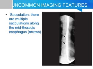 Corrosive injuries vishal | PPT