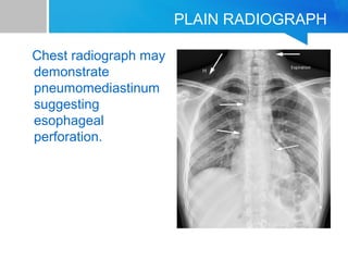 Corrosive injuries vishal | PPT