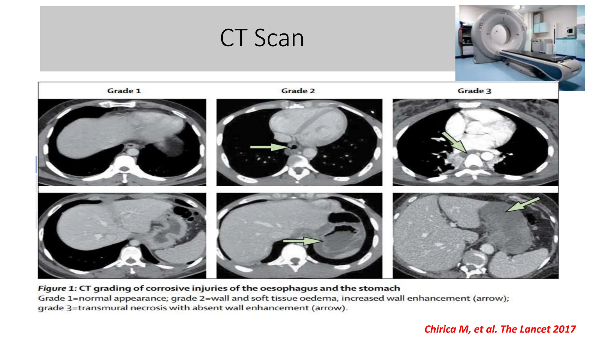 Corrosive injury review article and management.pptx