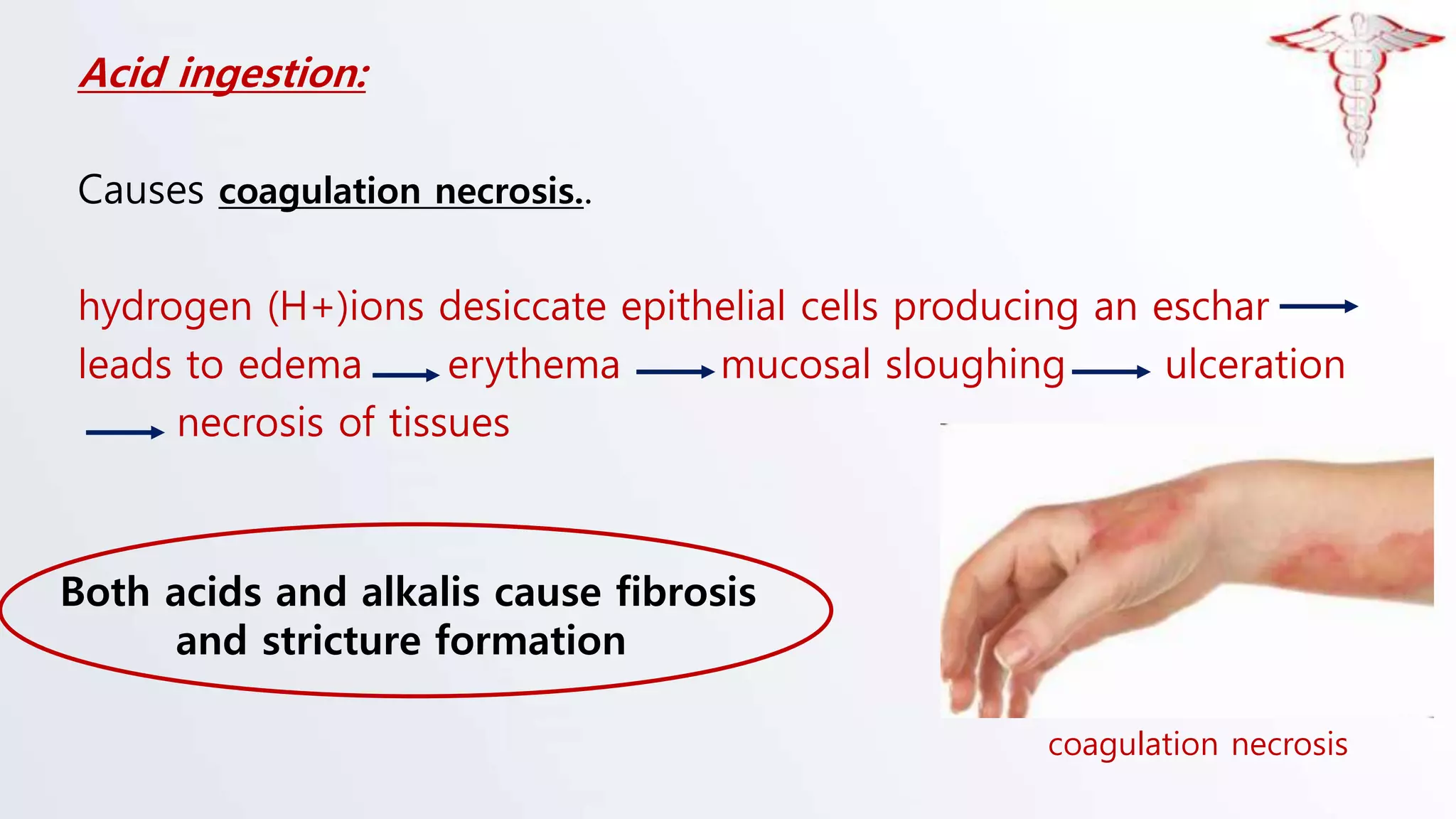 Corrosive poisoning | PPTX