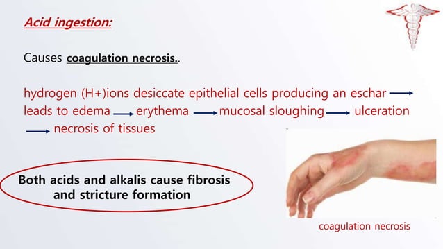 Corrosive poisoning | PPTX | Digestive Disorders | Diseases and Conditions