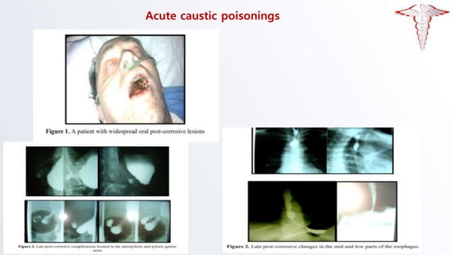 Corrosive poisoning | PPTX | Digestive Disorders | Diseases and Conditions