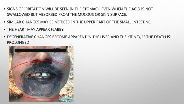 Corrosive poisons(hcl, h2so4, nitric acid, carbolic acid, oxalic and ...