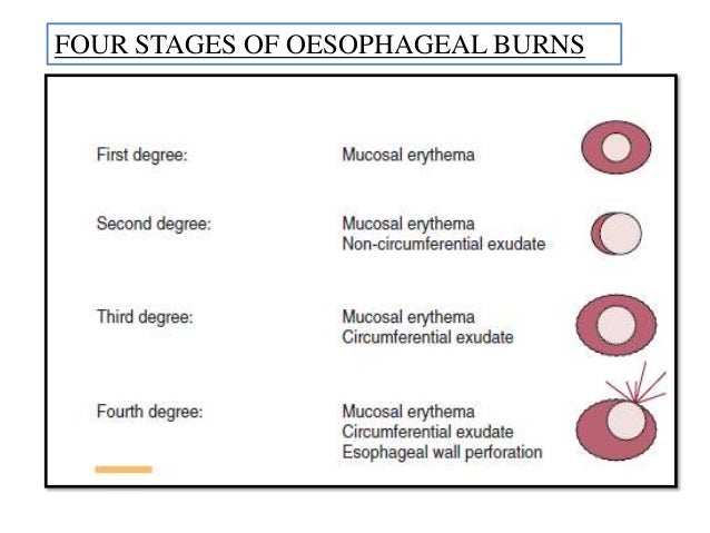 Corrosive poisoning by Dr.Ashwin Menon