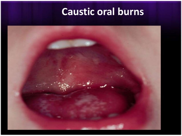 Toxicity of Corrosives